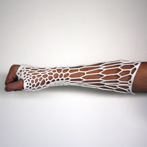 All About 3D-Printed Splints - Bitfab